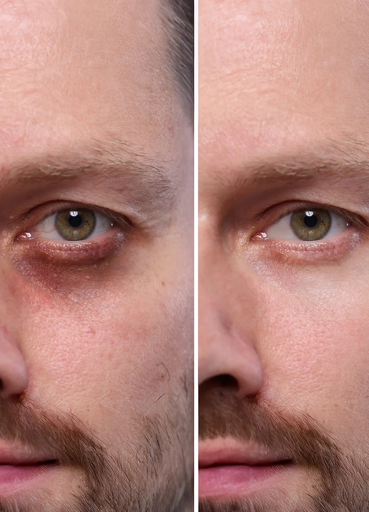 Under Eye Bags & Darkness in Men - Beauty Matched Med Spa